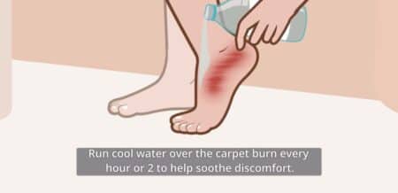 Understanding Rug Burns: 6 Powerful Points to Consider! - Rouzati Rugs